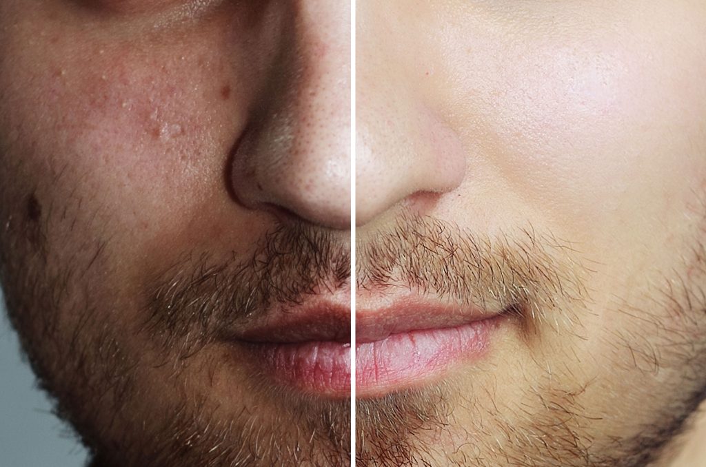 Achieving Radiant Skin with TCA Peel: A Complete Guide - Picnob